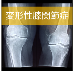 膝関節のFTA（femoro-tibial angle）とは？計測方法や生理的外反の理由を解説！ | 白衣のドカタ
