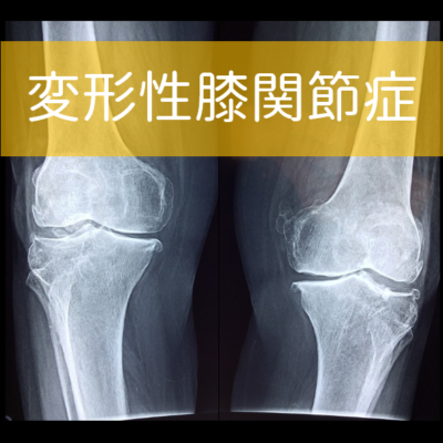 ミクリッツ線（Mikulicz line）の正常は？測定方法を解説！ - 白衣のドカタ